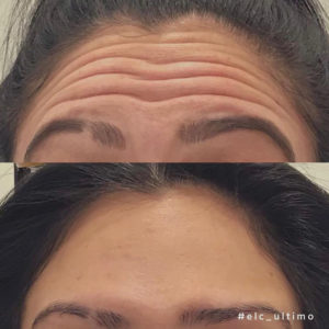 Skin Needling Sydney | Microneedling & Face Needling Treatment | ELC