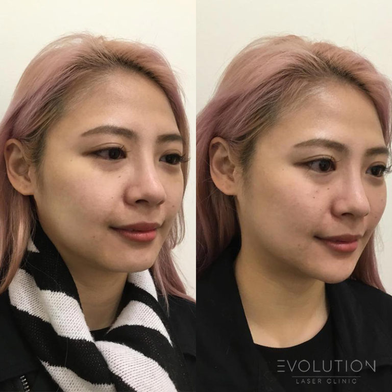 Best Laser Skin Clinic Sydney | Skin Care Clinic | Evolution Laser Clinic
