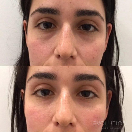 Tear Trough Filler | Under Eye Filler | Evolution Laser
