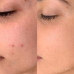 Best Laser Skin Clinic Sydney | Skin Care Clinic | Evolution Laser Clinic