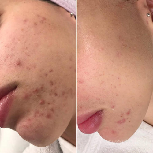 Acne Reduction Treatment Sydney | Laser Treatment For Acne | ELC