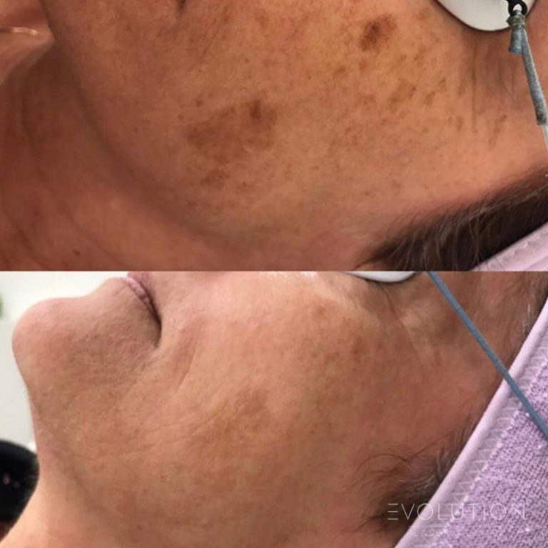 Laser Pigment Reduction Sydney | Best Laser Pigment Removal | ELC