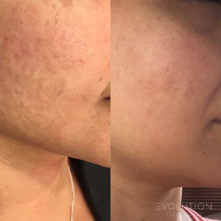 Best Laser Skin Clinic Sydney | Skin Care Clinic | Evolution Laser Clinic