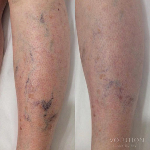Laser Vein & Capillary Treatment & Removal | Evolution Laser Clinic