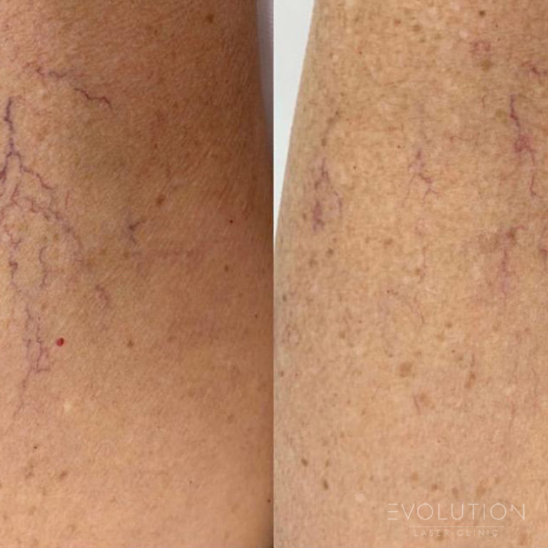 Laser Vein & Capillary Treatment & Removal | Evolution Laser Clinic