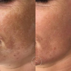 Melasma Treatment Sydney | Laser Treatment For Melasma | ELC