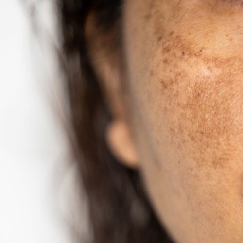 Melasma Treatment Sydney | Laser Treatment For Melasma | ELC