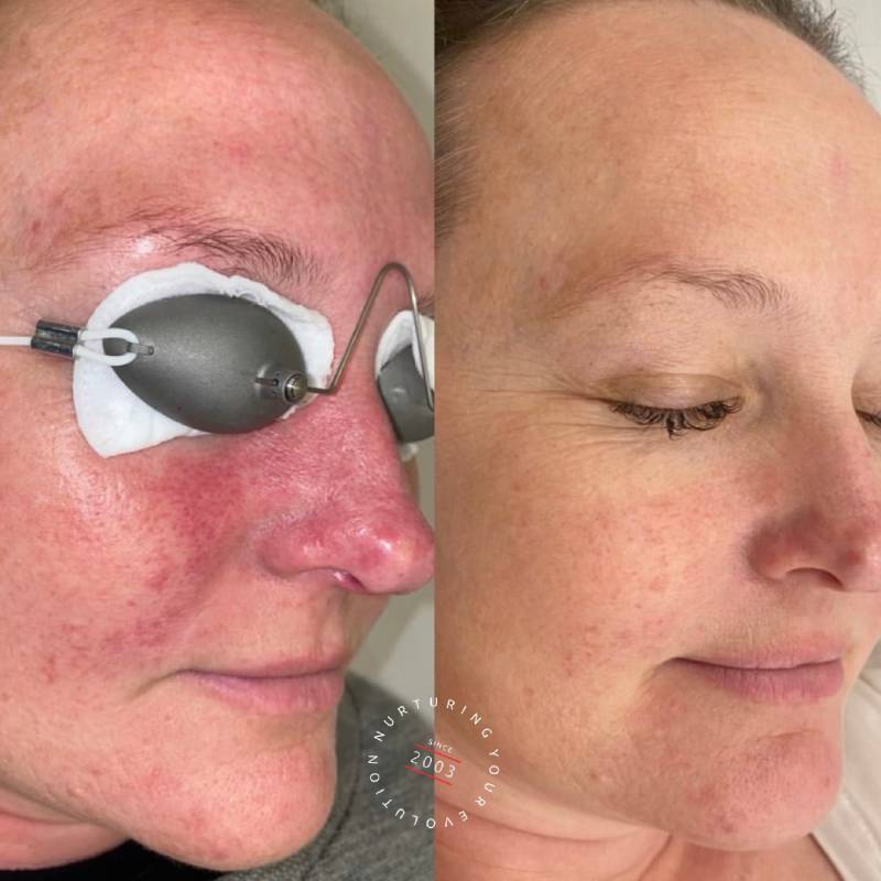 New Rosacea Treatment 2025 - Billi Cherise New Rosacea Treatment 2025 - Billi Cherise