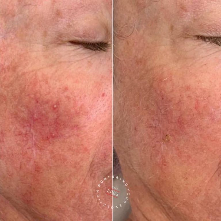 Treating Rosacea | Laser Treatment For Rosacea | ELC