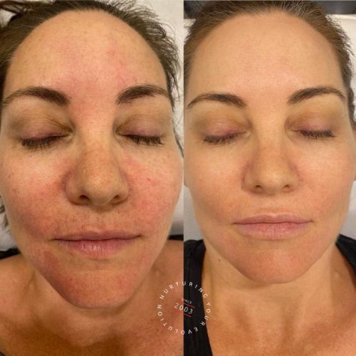 Treating Rosacea | Laser Treatment For Rosacea | ELC