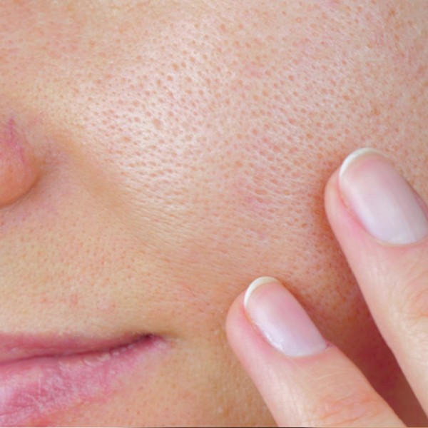 Enlarged Pores Treatment | Laser Treatment For Pores | ELC Enlarged Pores Treatment | Laser Treatment For Pores | ELC