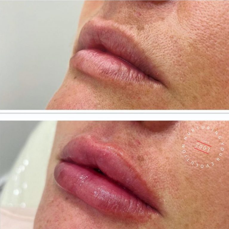 Lip Injections Sydney | Lip Fillers | Evolution Laser Clinic