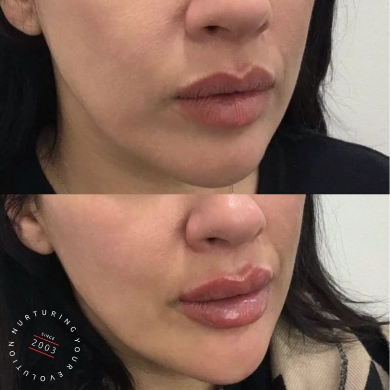 Lip Injections Sydney | Lip Fillers | Evolution Laser Clinic