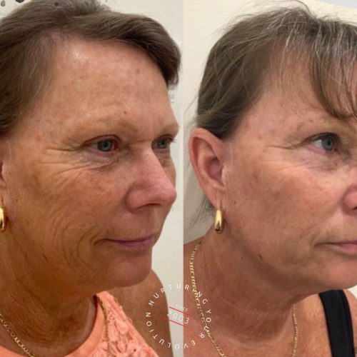 Skin Tightening Treatment Sydney | Laser Skin Tightening | ELC