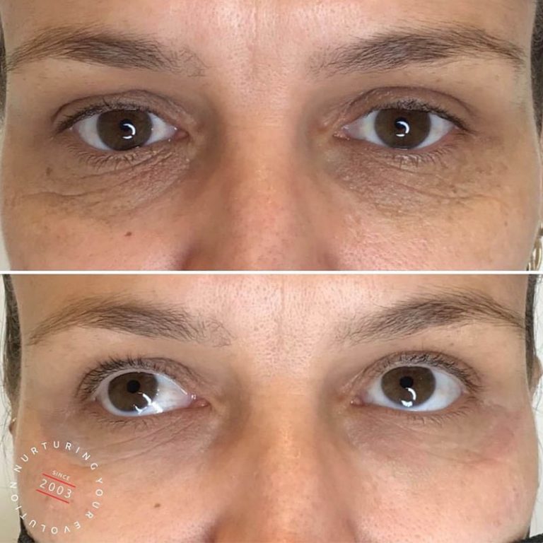 Tear Trough Filler | Under Eye Filler | Evolution Laser