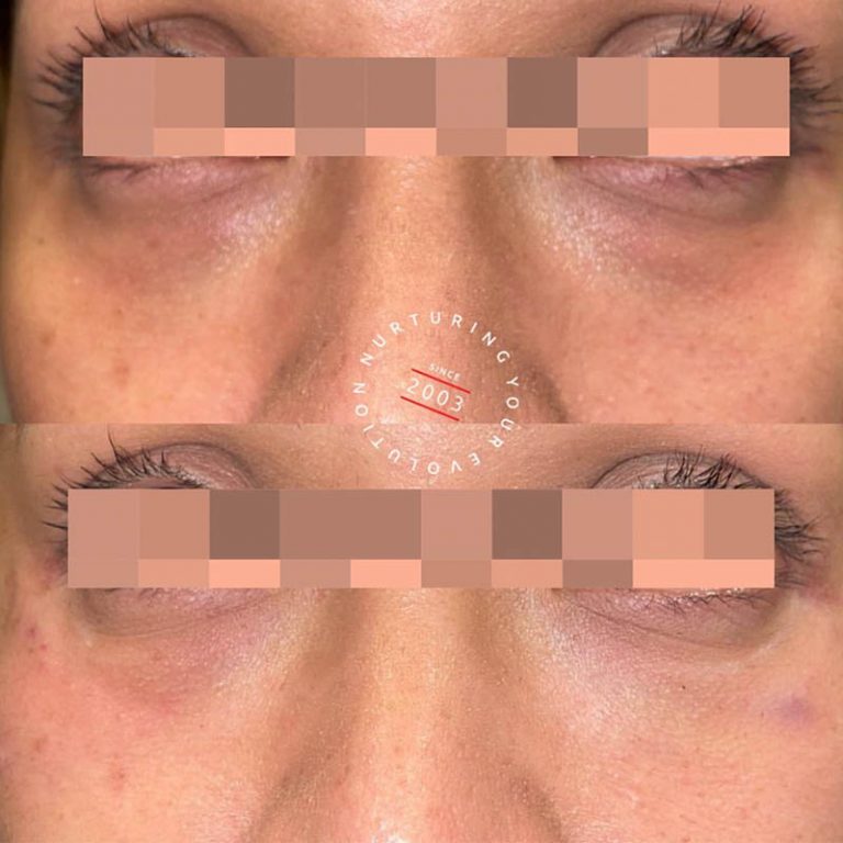 Tear Trough Filler | Under Eye Filler | Evolution Laser