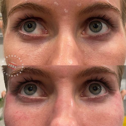 Tear Trough Filler | Under Eye Filler | Evolution Laser