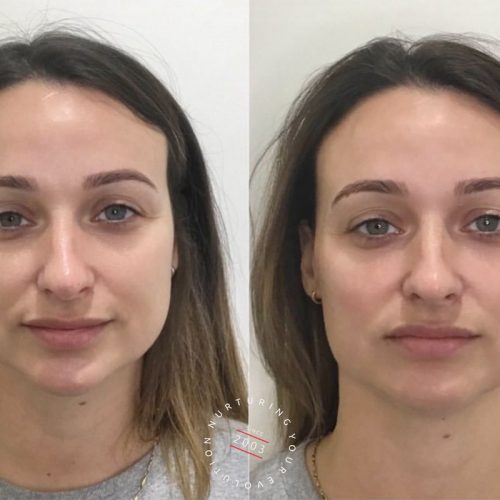 Tear Trough Filler | Under Eye Filler | Evolution Laser