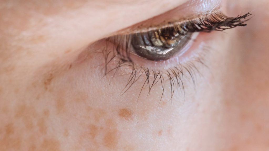 How Skin Needling Helps with Acne Scars & Pigmentation - Evolution ...