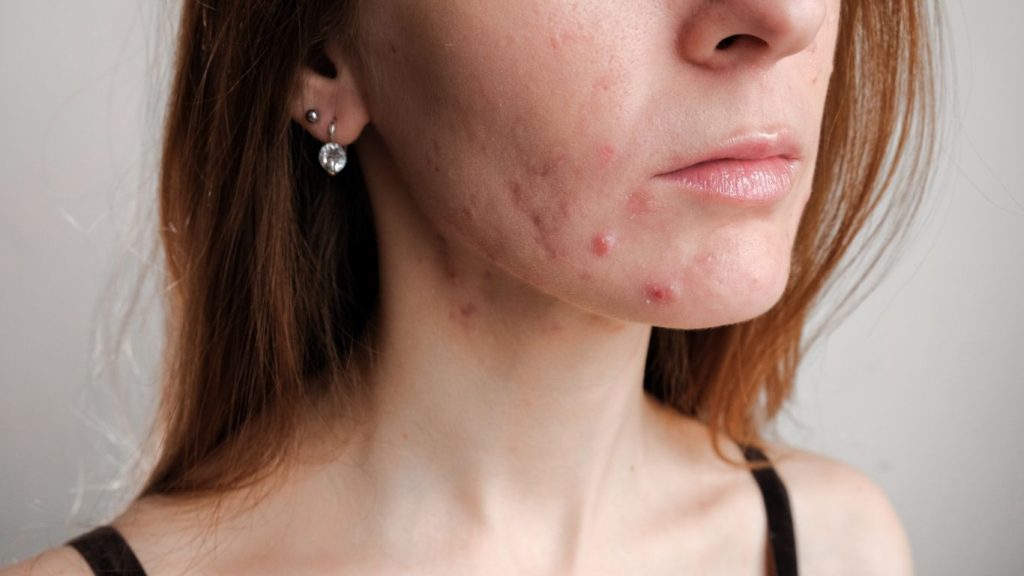 Does Blue LED Light Really Work for Acne? - Evolution Laser Clinic